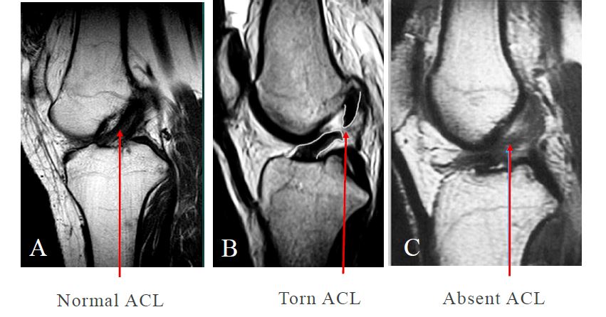 ACL, Anterior Cruciate Ligament Tear Treatment & surgery in Chennai
